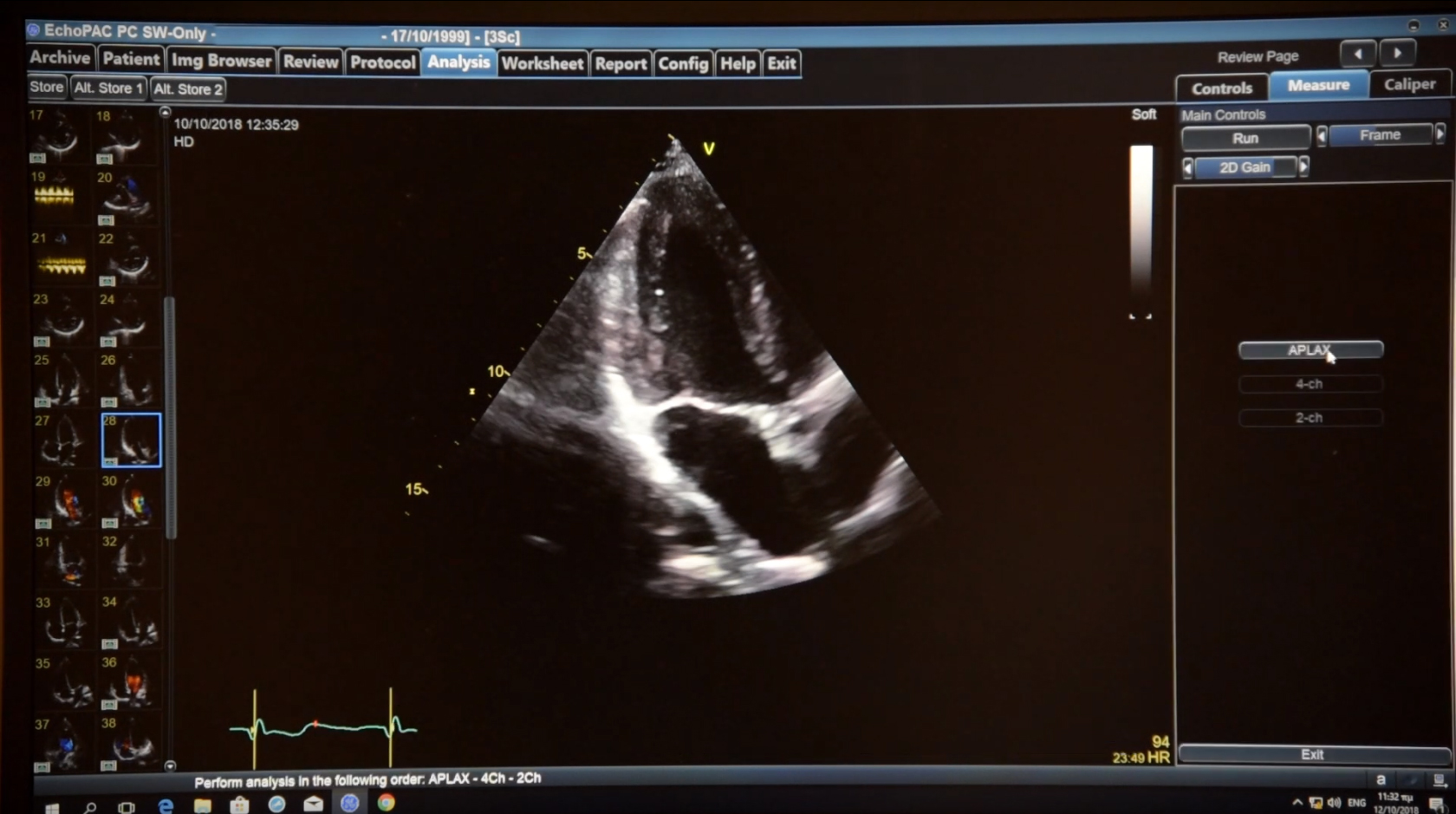 Evaluation of left ventricle longitudinal strain AFI - heartteam.gr